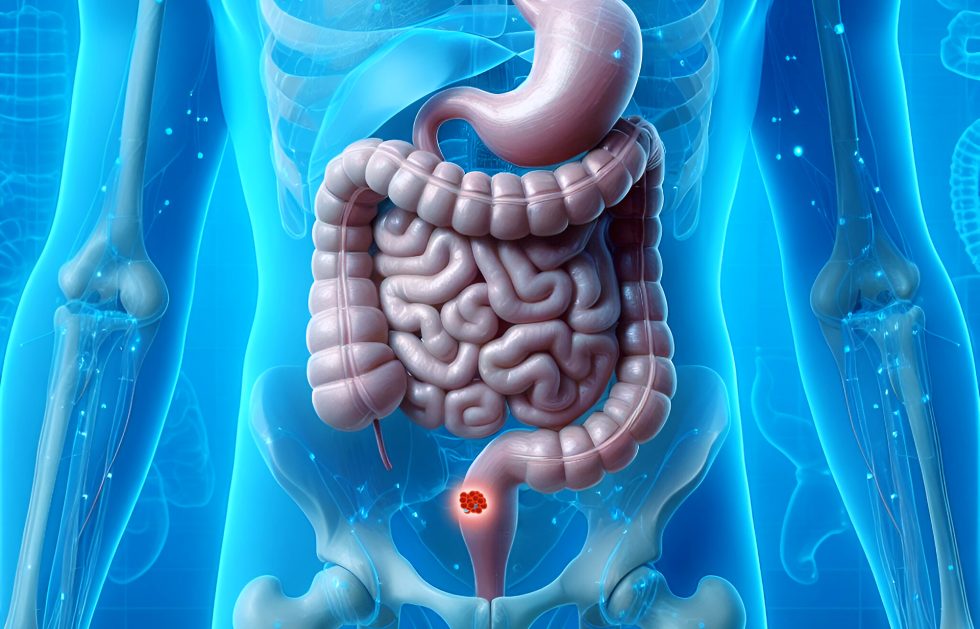 Open Day dedicated to colorectal cancer | SDIR